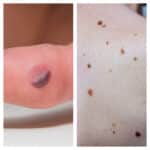 Blood Blister vs Melanoma: How to Tell Them Apart?